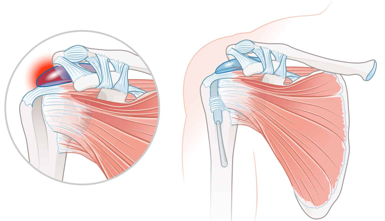 Shoulder Injuries You Should Be Aware Of | Intecore